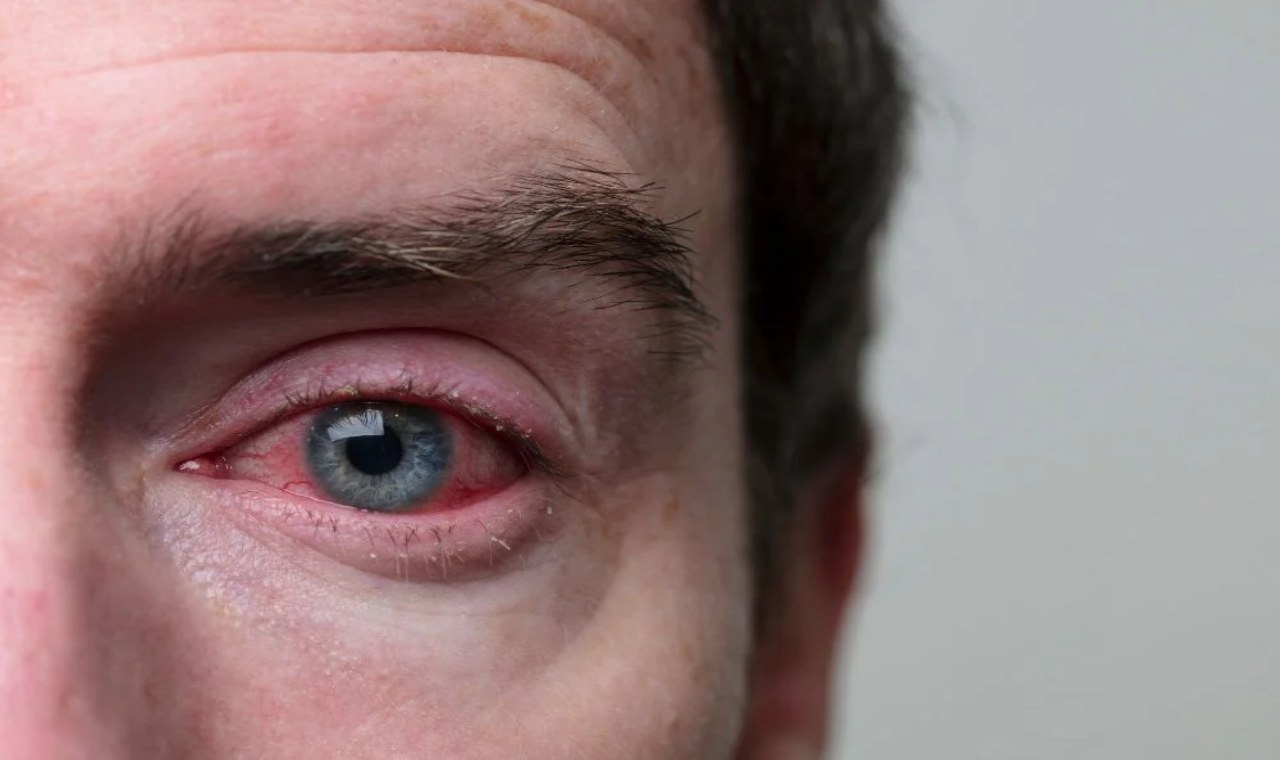 If your eyes are red, rinse them with clean water. Use cold water for ...