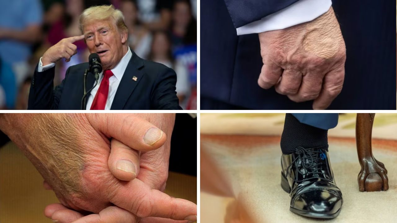 Donald Trump Marks on hands swelling in legs| American president is ...