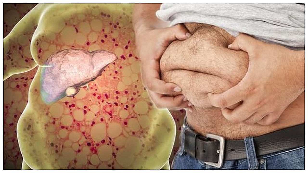 fatty liver disease symptoms causes prevention and treatment Latest ...